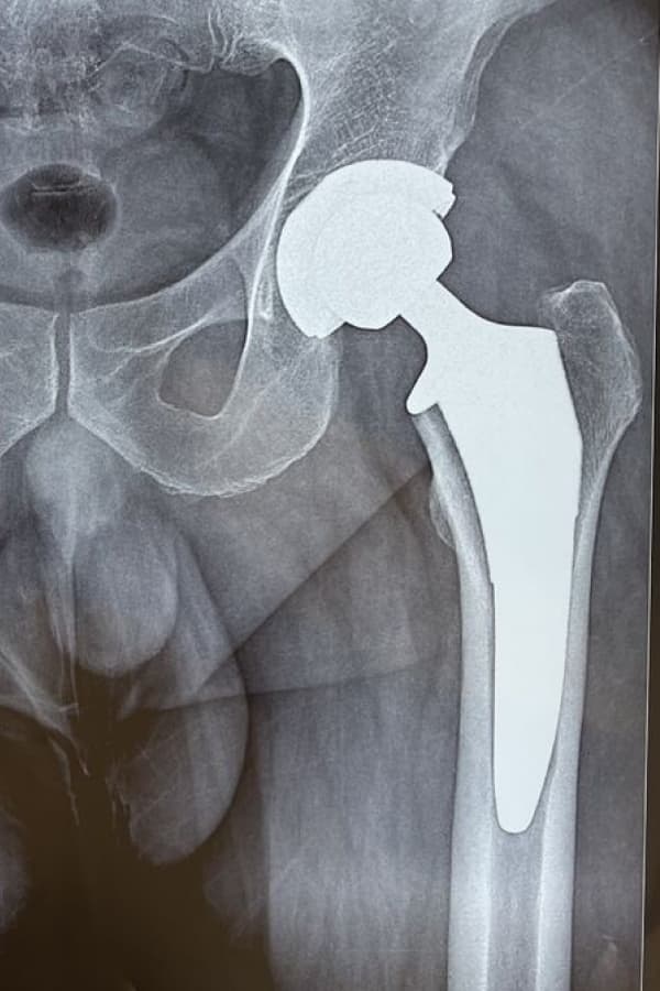 Anterior Hip Replacement Boise | Total Hip Replacement